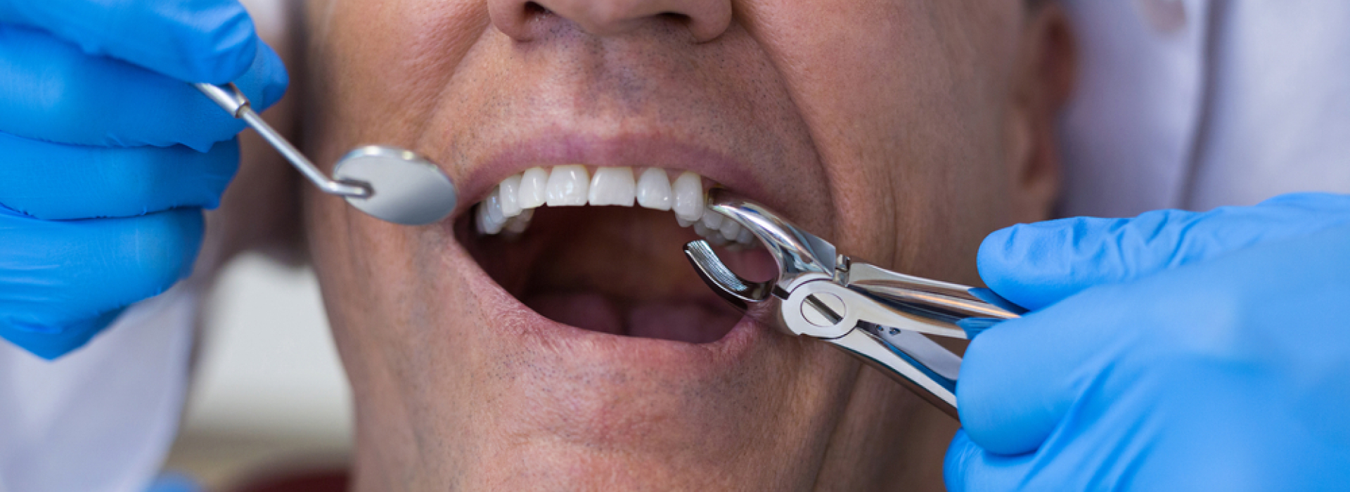 Tooth Extraction in Flower Mound TX | Wisdom Teeth Removal Tooth Extraction in Flower Mound TX | Wisdom Teeth Removal